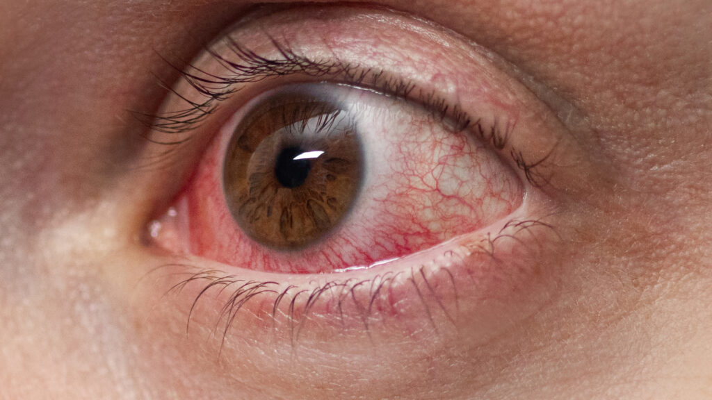 Esclera: Conheça duas doenças que podem afetar essa parte dos olhos ...