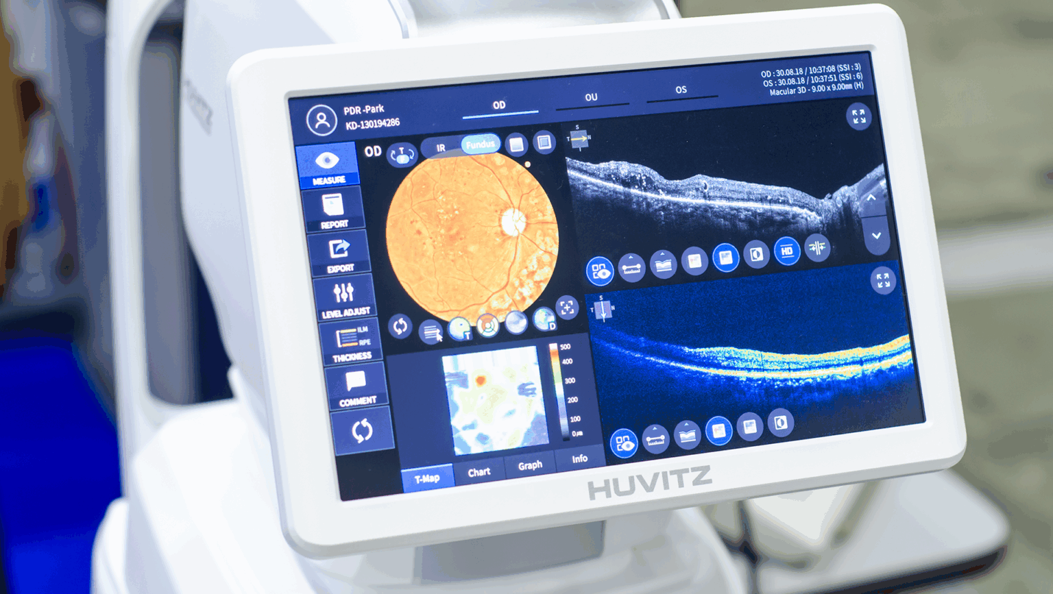 Exames de imagem da retina: Tudo sobre Tomografia de coerência óptica e ...